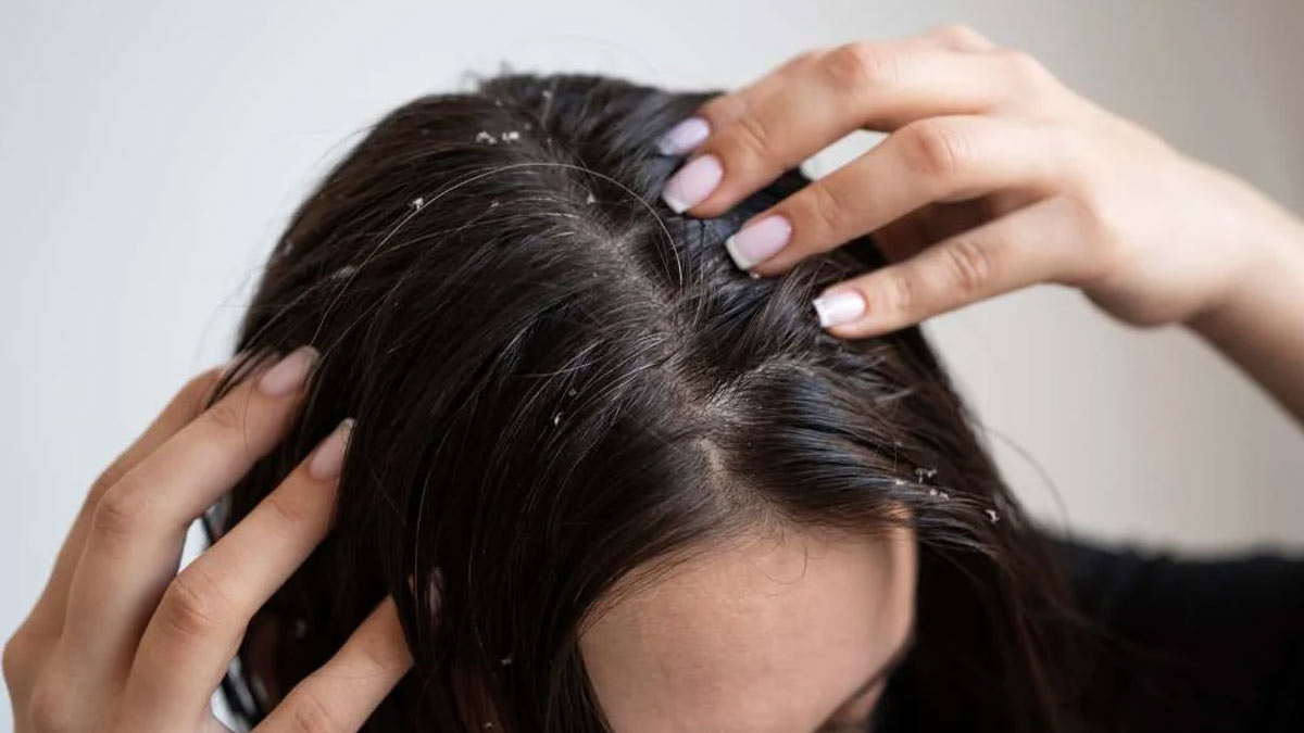 4 Home Remedies to Get Rid of Dandruff in Winter | HerZindagi