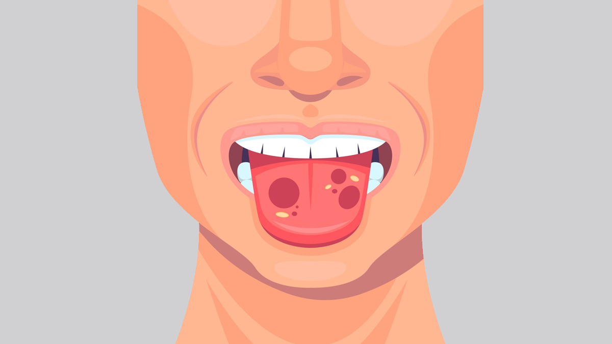 Top 6 Tongu e Colour Changes That Could Reveal Hidden Illnesses ...