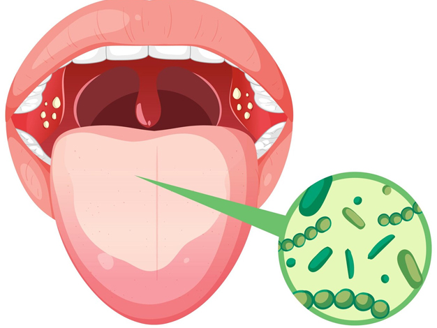 Top 6 Tongu e Colour Changes That Could Reveal Hidden Illnesses ...