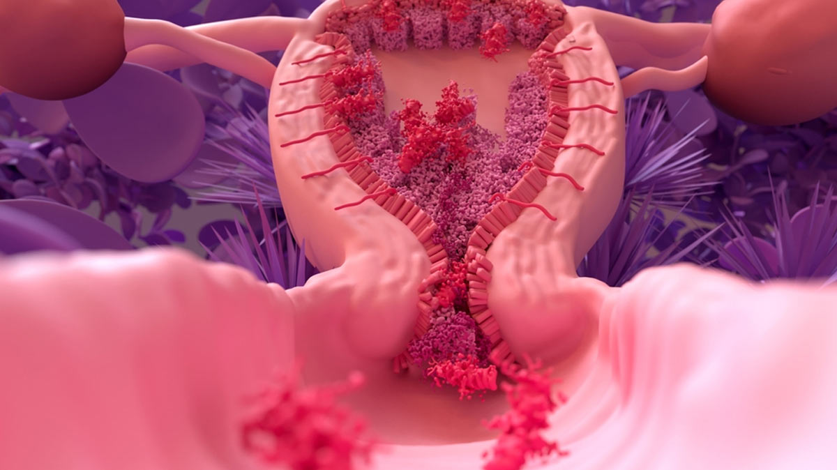 क्या आप जानती हैं Cold Uterus क्या होता है और कैसे यह आपकी Fertility पर ...