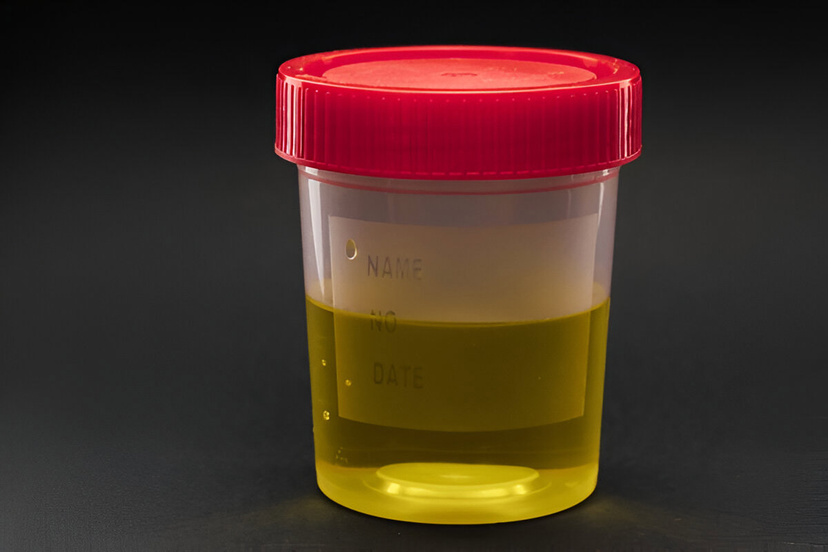 Expert Tips: सुबह का पेशाब पीला क्यों आता है? जानें | why is my urine ...