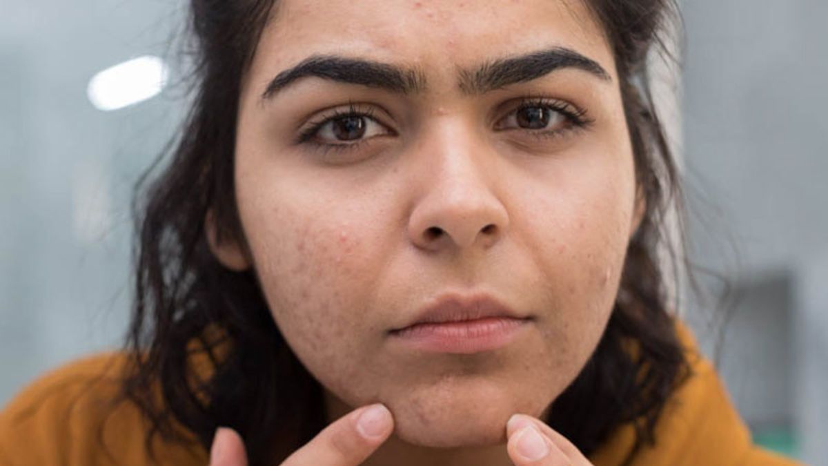 Chin Hair Removal: ठुड्डी पर आ रहे अनचाहे बालों से हैं परेशान? कमाल कर ...