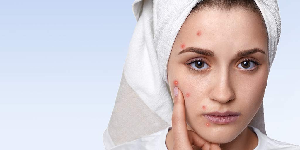 4 Different Skin Conditions That Are Often Considered As Acne | 4 ...