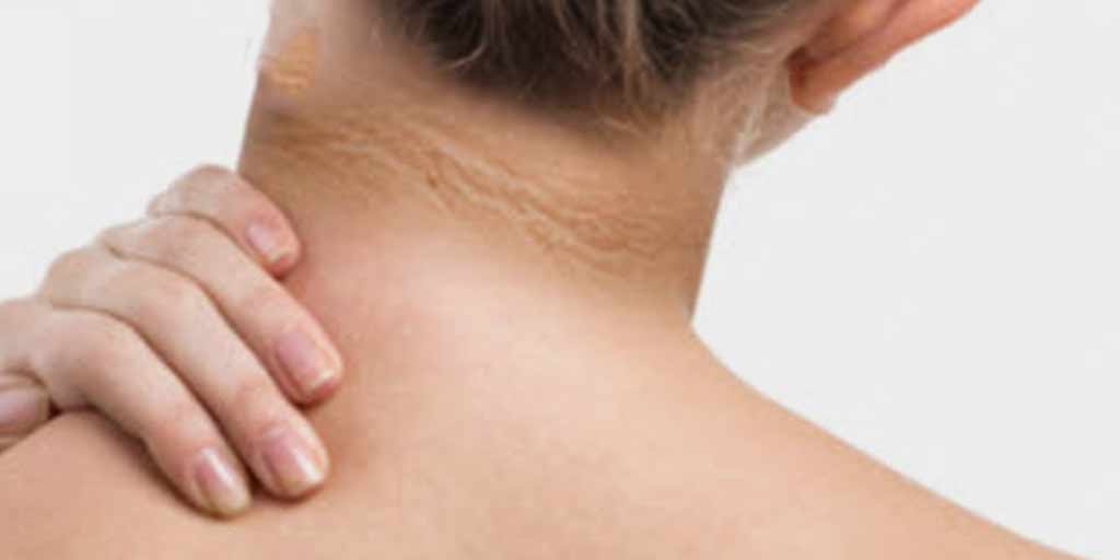 Winter Skin Care Tips For Removing Neck And Back Pigmentation ...