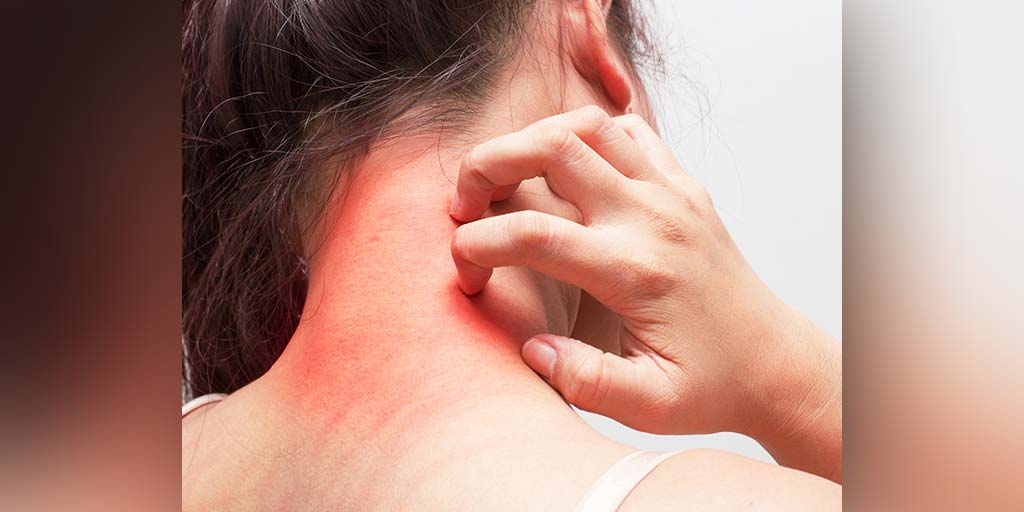 Ringworm Eczema and Itching Treatment With This Flower in Seven Days ...