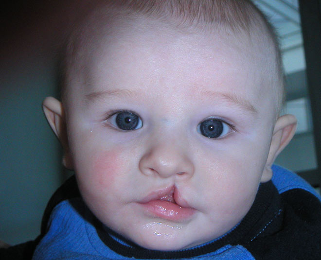 Cleft Lip Causes Symptoms Diagnosis and Treatment By Expert | cleft lip ...