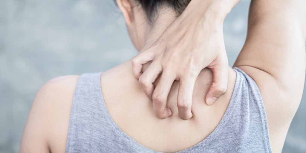 5 Easy Homemade Gharelu Nuskhe For Back Acne Or Pimples