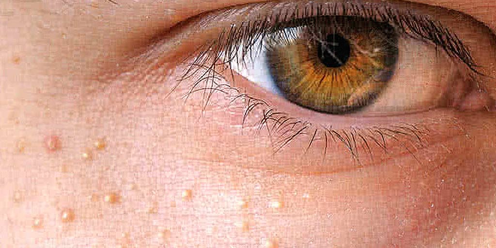 Skin Care Tips: Effective Remedies for Milia Skin Problem Treatment by ...