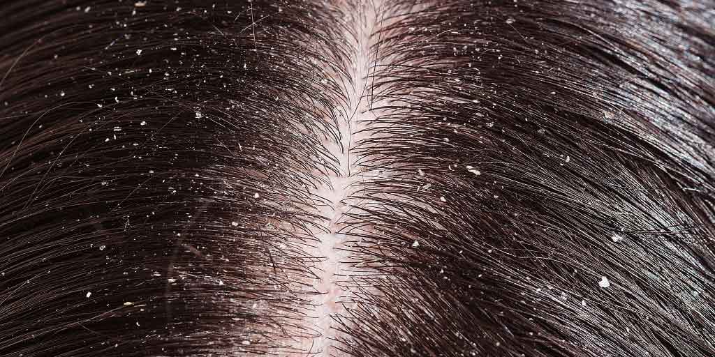 What Causes Dandruff, Is It Contagious?Here Is All You Need To Knowv