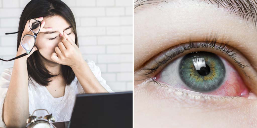 How To Get Rid Of Red Eyes Problem In Hindi -इन आसान उपायों से दूर करें ...