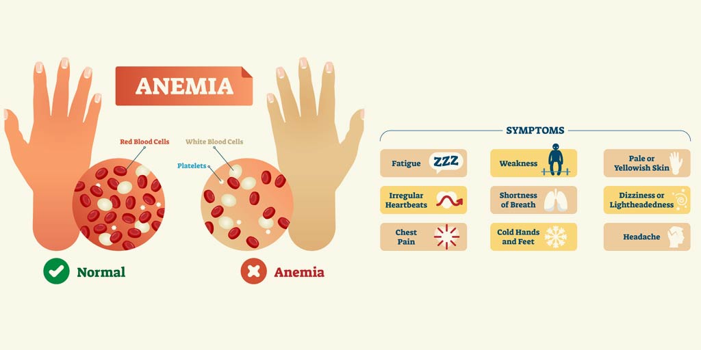 What Causes Iron Deficiency & How to Prevent Anemia-What Causes Iron ...