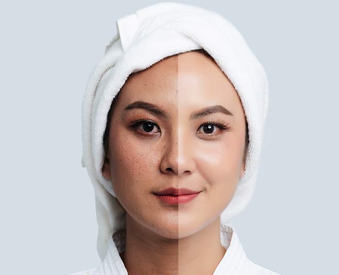 Patches Of Dark Skin On The Face During Pregnancy Patches Of Dark