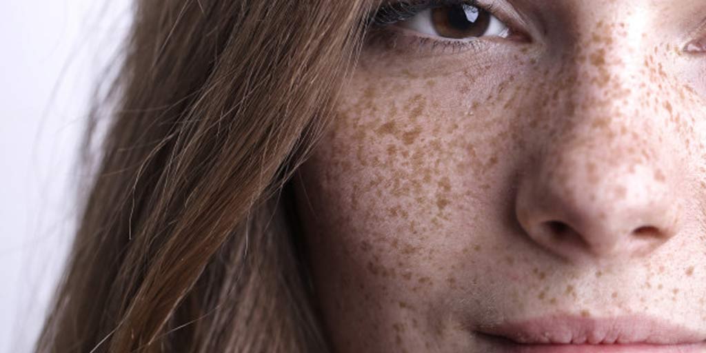 Longing For A Freckle-Free Skin? These Home Remedies Are A Must-Try
