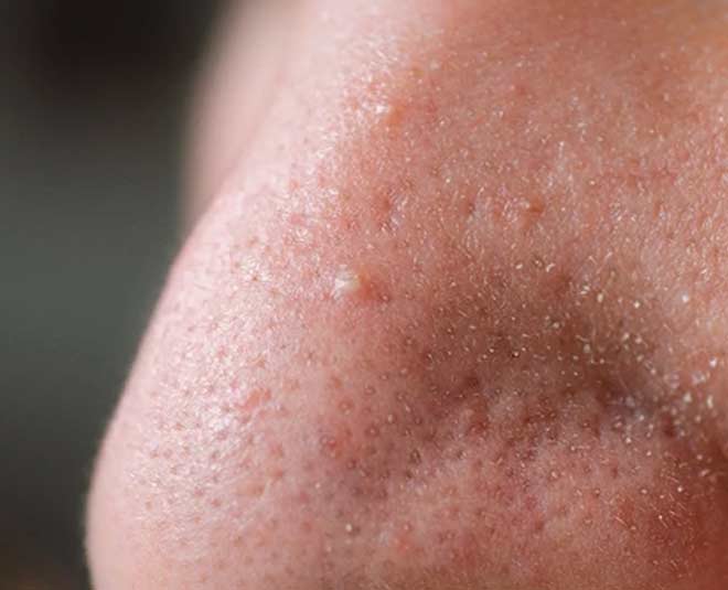 4 Different Kinds Of Bumps On Face And Their Symptoms 4 Different 4 Different Kinds Of Bumps On Face And Their Symptoms 4 Different