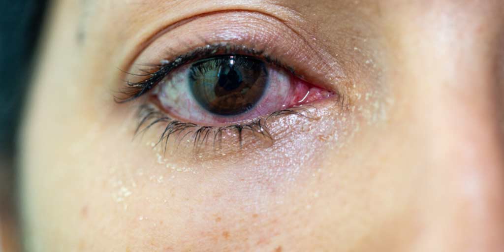 Expert Shares Home Remedies To Treat Watery Eyes -Expert Shares Home ...