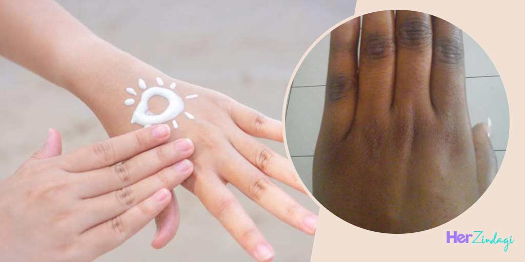 Hand Tanning Remedies by Expert -Expert Tips: हाथों का कालापन दूर करने ...