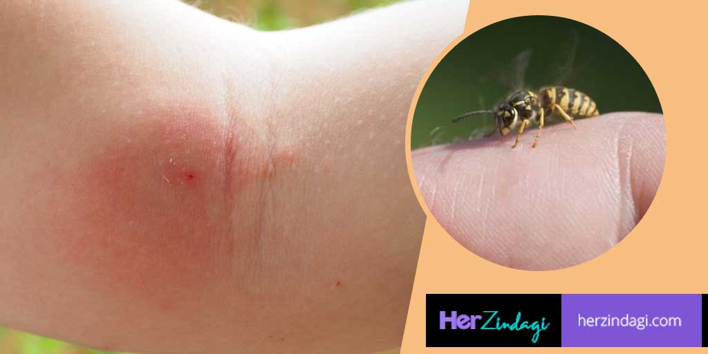 6 Home Remedies For Bee Stings-अगर काट ले मधुमक्खी तो इन घरेलू नुस्ख़ों ...