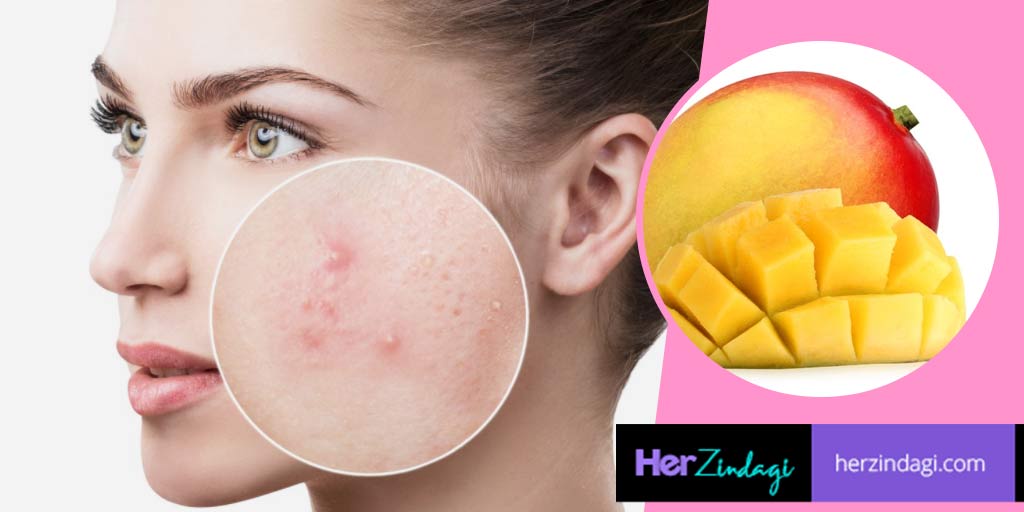 Mango Face Pack To Prevent Blackheads And Pimple By Sheeba Akashdeep ...