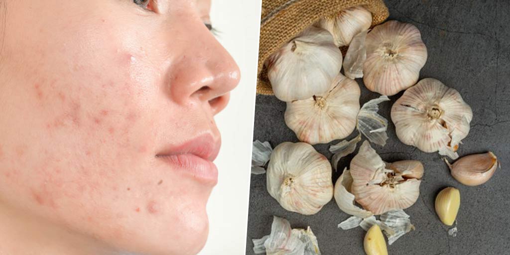Here’s How You Can Use Leftover Garlic Skin To Fight Pimples-Here’s How ...