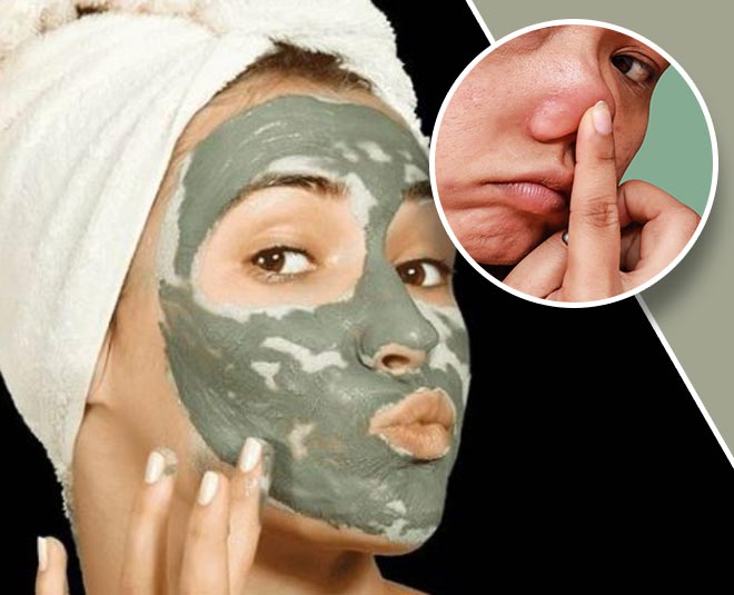 Face Masks For Acne Prone Skin Sensitive Skin Under Rs 700 HerZindagi