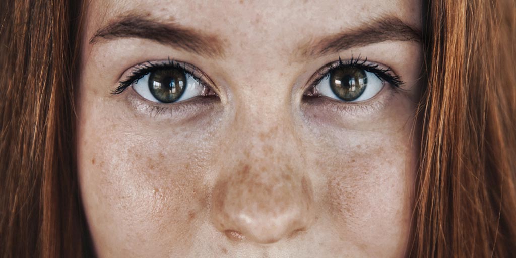 Expert Tips: Pigmentation Around Eyes Remedies -आंखों के पास होने वाले ...
