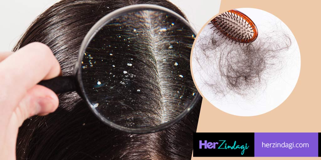 Home Remedies for Dandruff Hair Fall -डैंड्रफ के कारण झड़ते हैं आपके ...