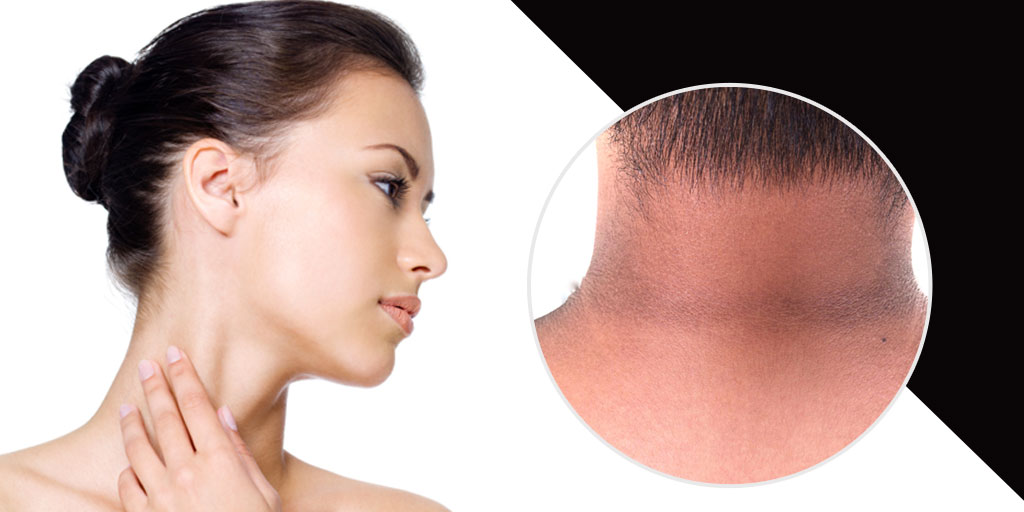 2 Remedies for Dark Neck and Elbows - गर्दन के कालेपन को 7 दिनों में ...