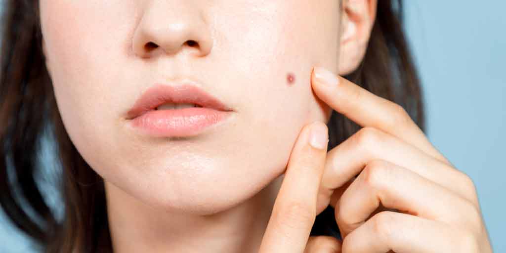 Til Or Mole Suddenly Appearing On Body Reveal These Secrets | til or ...