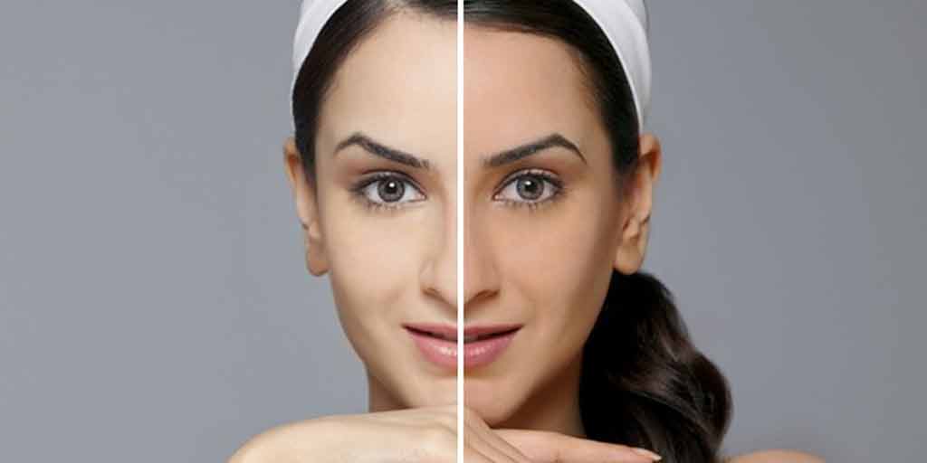 Patchy Or Uneven Skin Tone Try These 5 Natural Homemade Remedies in ...