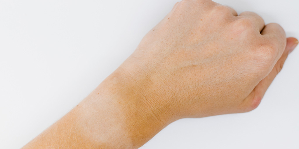 Get Rid Of Arm Tan With These Home Remedies -Get Rid Of Arm Tan With ...