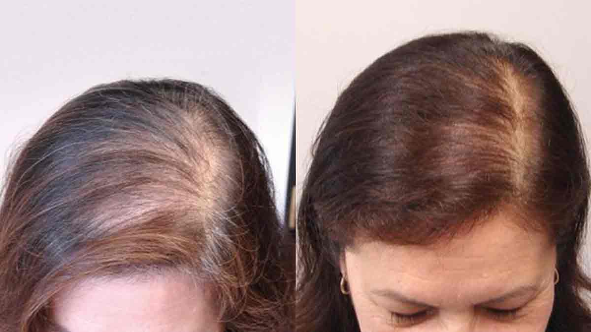 How to Reduce Hair Fall at Home For Female| बालों के झड़ने के कारण ...