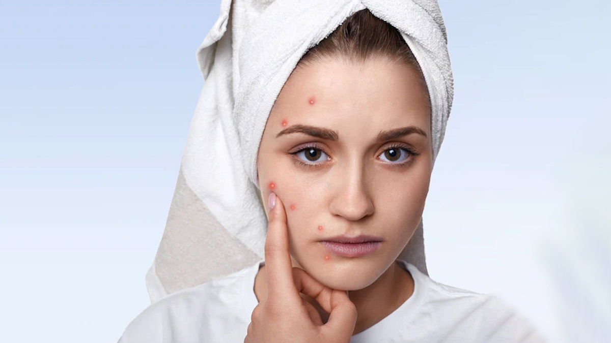 How To Hide A Pimple Without Makeup