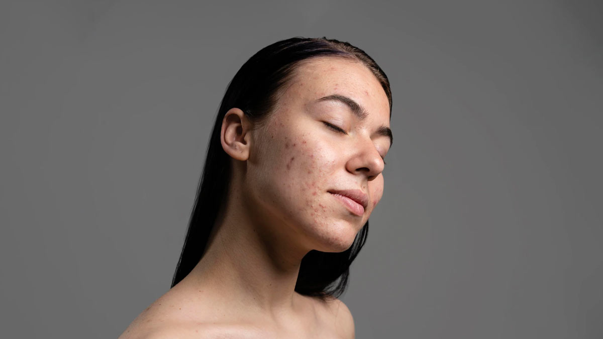 Acne Breakout| एक्ने ब्रेकआउट क्यों होते हैं| Acne Breakout Ke Liye ...