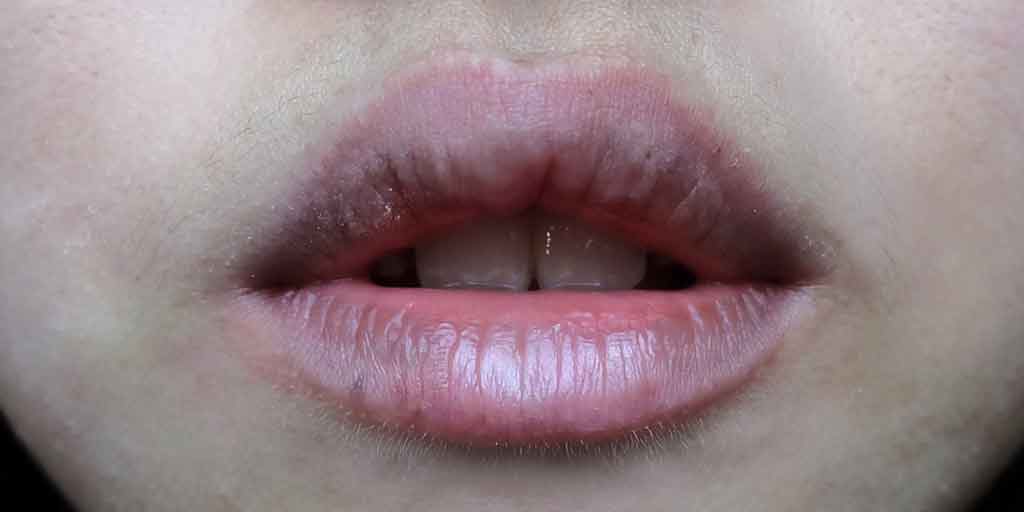 Expert Tips on dark lips treatment | dark lips treatment with kitchen ...