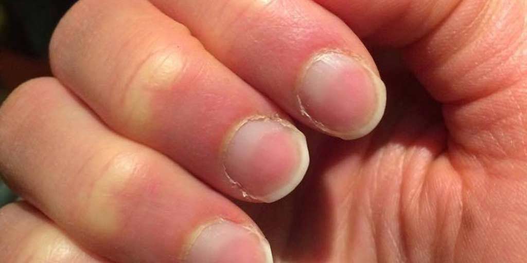 9 Changes in Nails Tell You Need to See a Doctor | 9 changes in nails ...