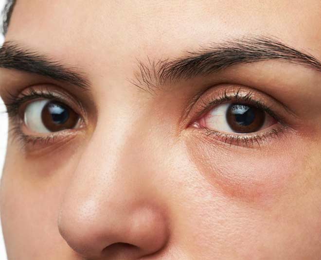 How to Deal With Face Puffiness | how to deal with face puffiness ...