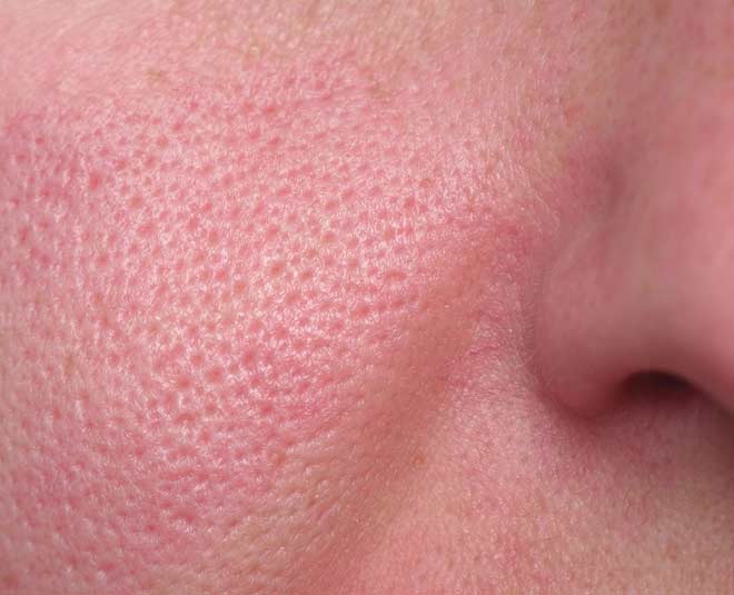 सर्दियों में फट जाते हैं गाल और चेहरा होता है लाल तो अपनाएं ये टिप्स ...