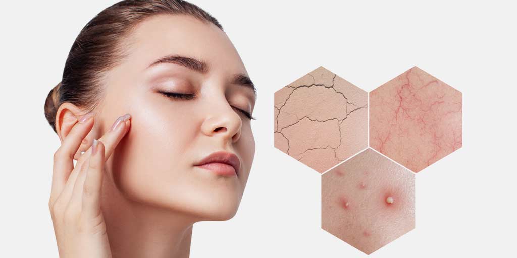 What to do if You Get Cold and Red Cheeks in Winter | what to do if you ...