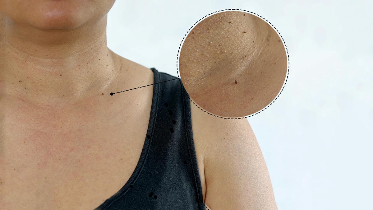 Skin Conditions from Diabetes| गर्दन पर मस्से क्यों होते हैं| Gardan ...