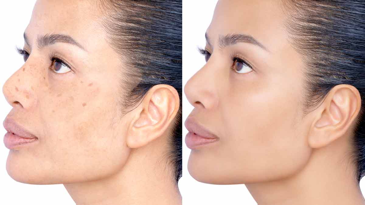 Dark Spots Treatment Kale Dhabbe Ka