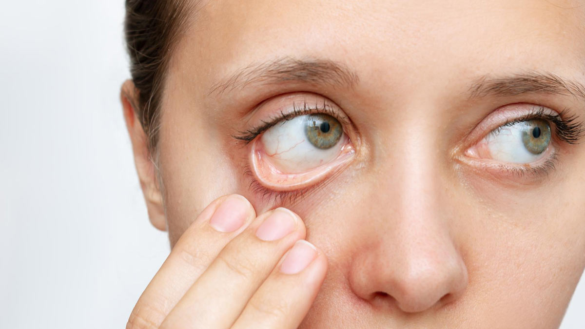 Dry Eyes In Winters: Causes And Prevention Tips | HerZindagi