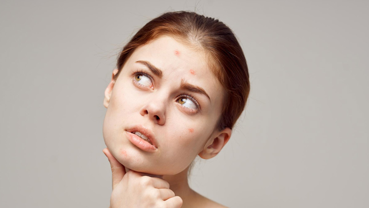 Face Acne Health Tips In Tamil | முகப்பரு உடனடியாக போக | mugaparu poga ...