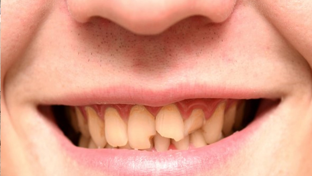 Powder for Strong Teeth| कमजोर दांतों का इलाज| Tooth Powder Ke ...