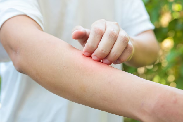 हीट रैश होने पर नहीं करनी चाहिए ये स्किन केयर मिसटेक्स | avoid these ...