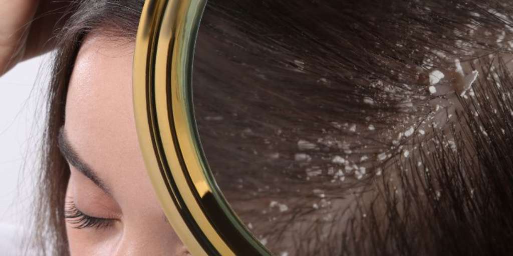 यह अजीबो गरीब नाम वाली सब्जी है डैंड्रफ का इलाज