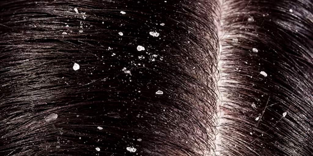 ஒரே நாளில் பொடுகை நீக்குவது எப்படி?